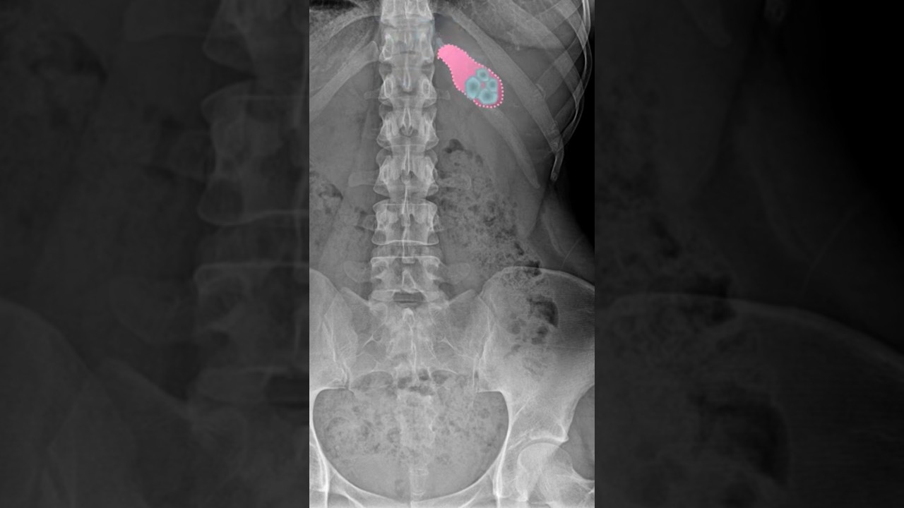 Gallstones Xray