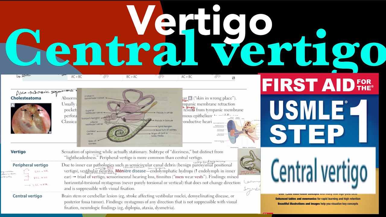 Central vertigo in Hindi/Urdu by first aid for USMLE step 1 - YouTube