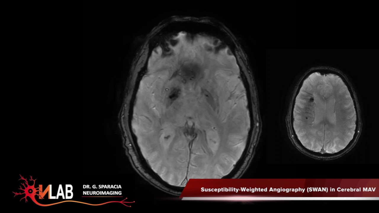 SWAN Brain MAV - YouTube