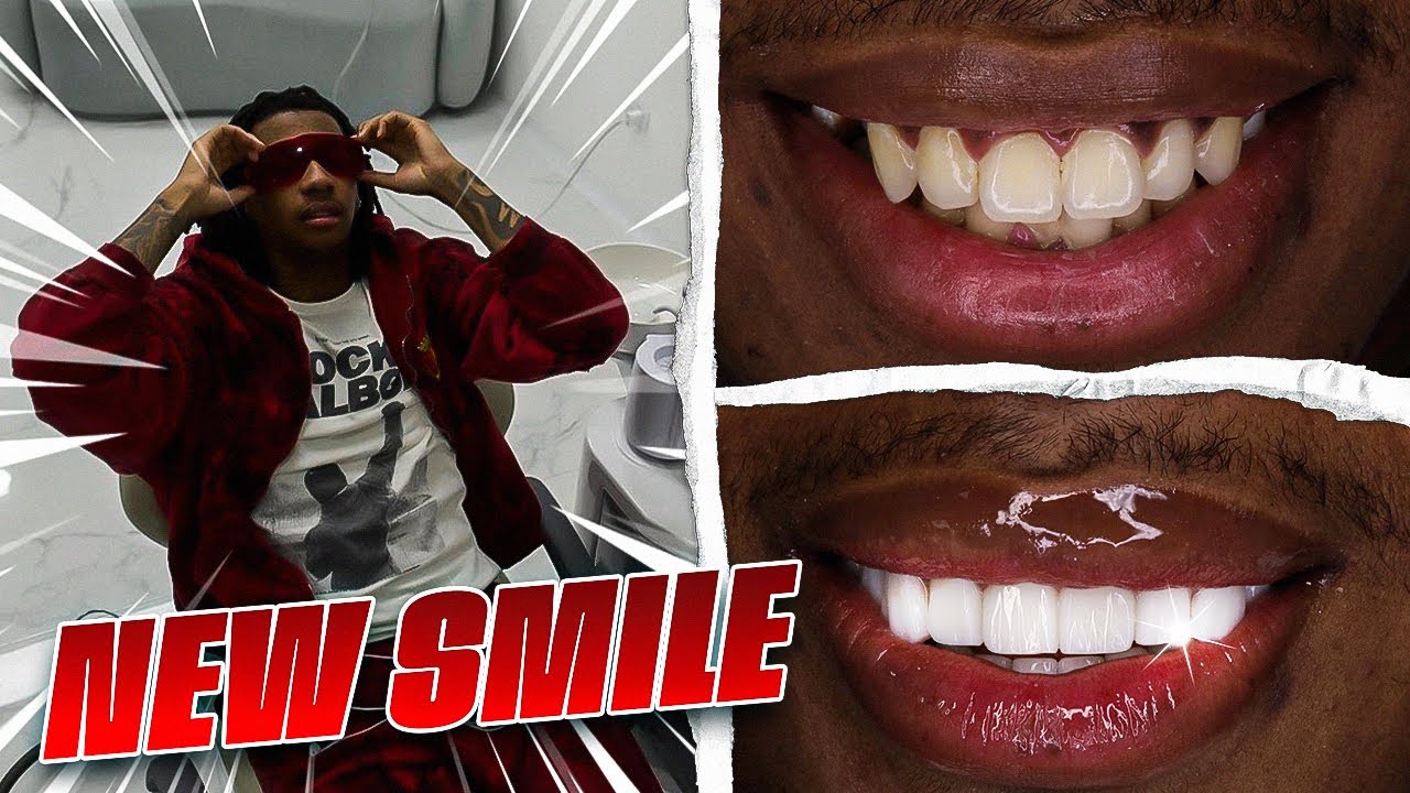 I GOT MY TEETH DONE IN COLUMBIA! BEST VENEERS EVER - YouTube