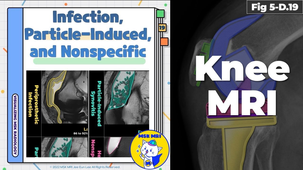 (Fig 5-D.19) Post-TKA Synovitis: Infection, Particle-Induced, and ...