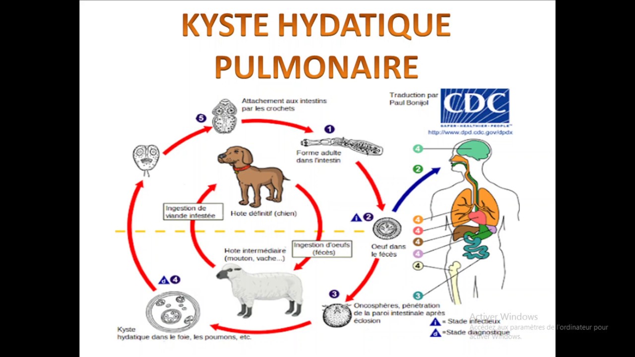 KYSTE HYDATIQUE PULMONAIRE - YouTube