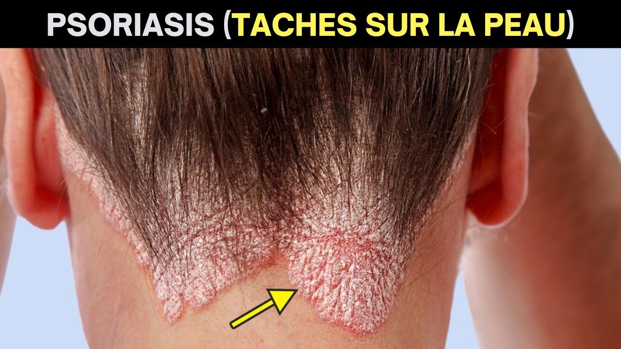 Psoriasis : symptômes et causes de cette maladie cutanée - YouTube