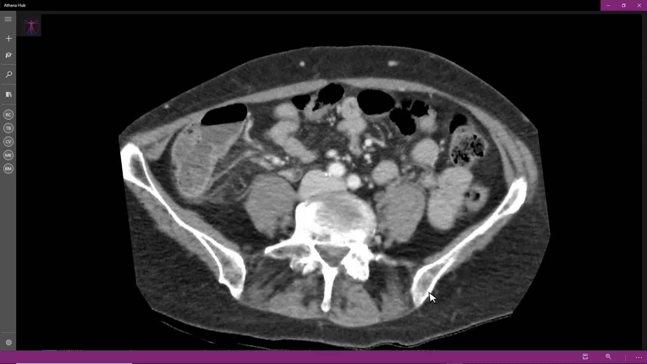 Apendicite aguda - YouTube