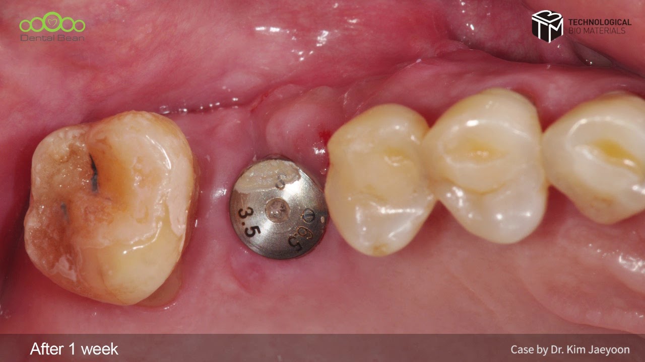 How to use Ora Aid properly 1 - YouTube