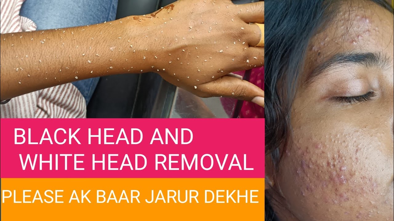 Black head and white head removal #shorts #youtubeshort # ...