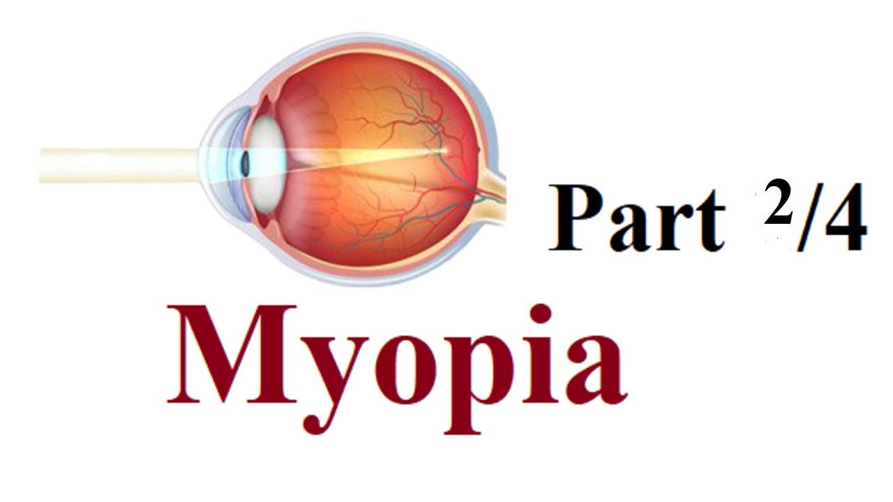 myopia - pathology and risk factors (Part 2/4) - YouTube