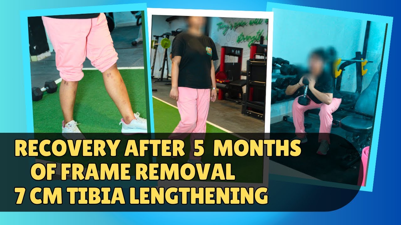Recovery After 5 Months of Frame Removal 7 cm Tibia lengthening ...