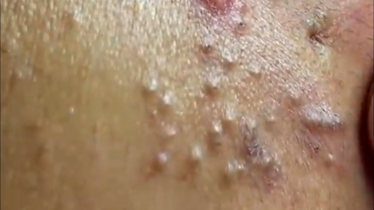 Pee Kung presses acne 541 large pimples implanted with a bulge for more ...