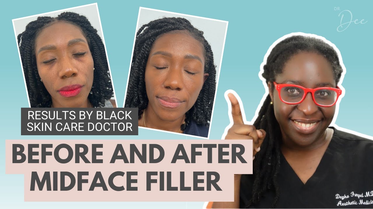 MID FACE FILLER BEFORE AND AFTER | BLACK SKIN CARE DOCTOR - YouTube