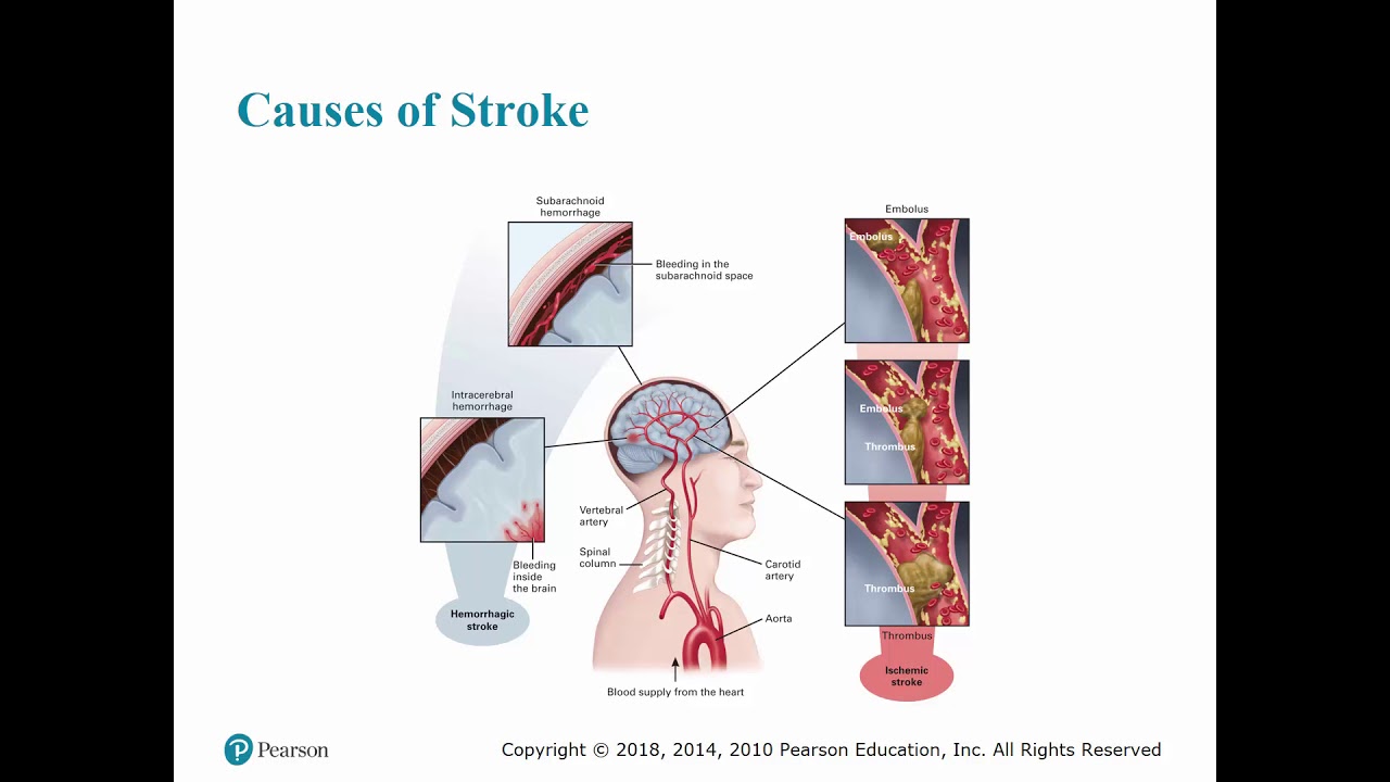 Chapter 18 AMS, CVA, & Headache - YouTube