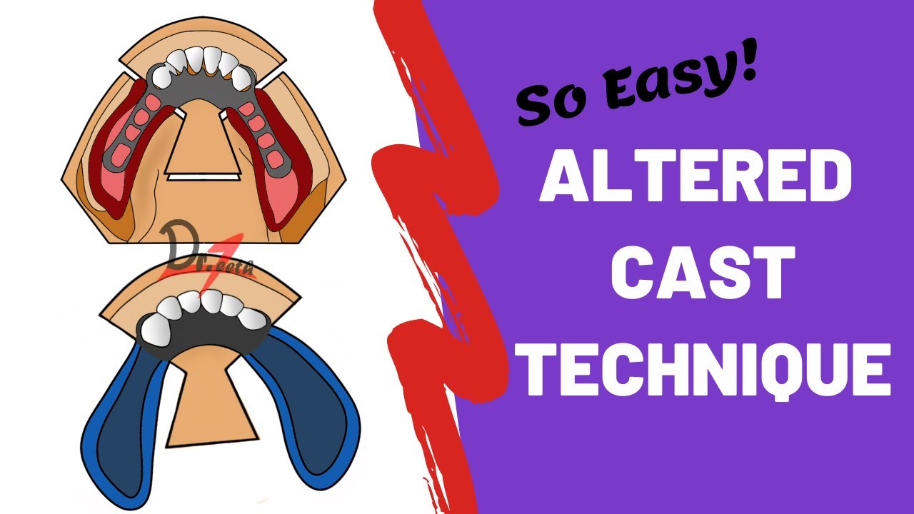 Altered Cast Technique in Prosthodontics - YouTube