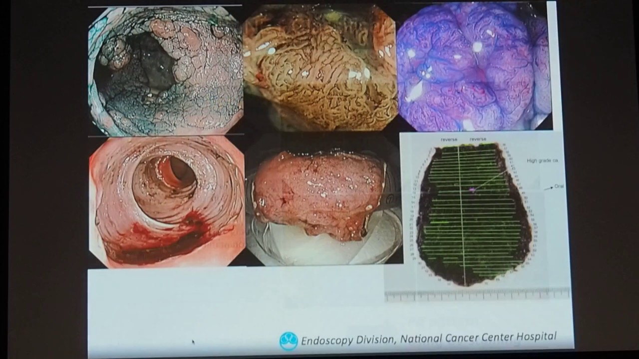 06 Yutaka Saito Endoscopic Diagnosis using JNET classification and ...