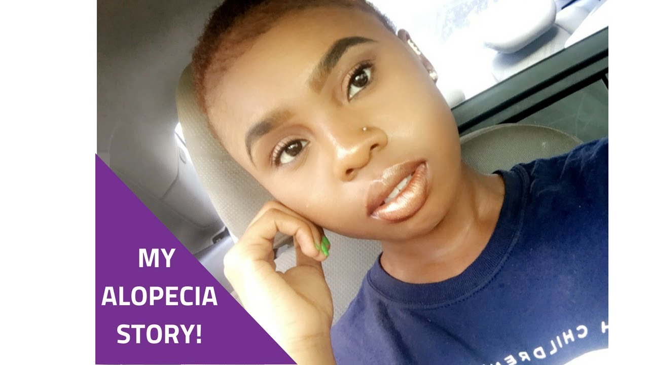 MY ALOPECIA STORY! - YouTube