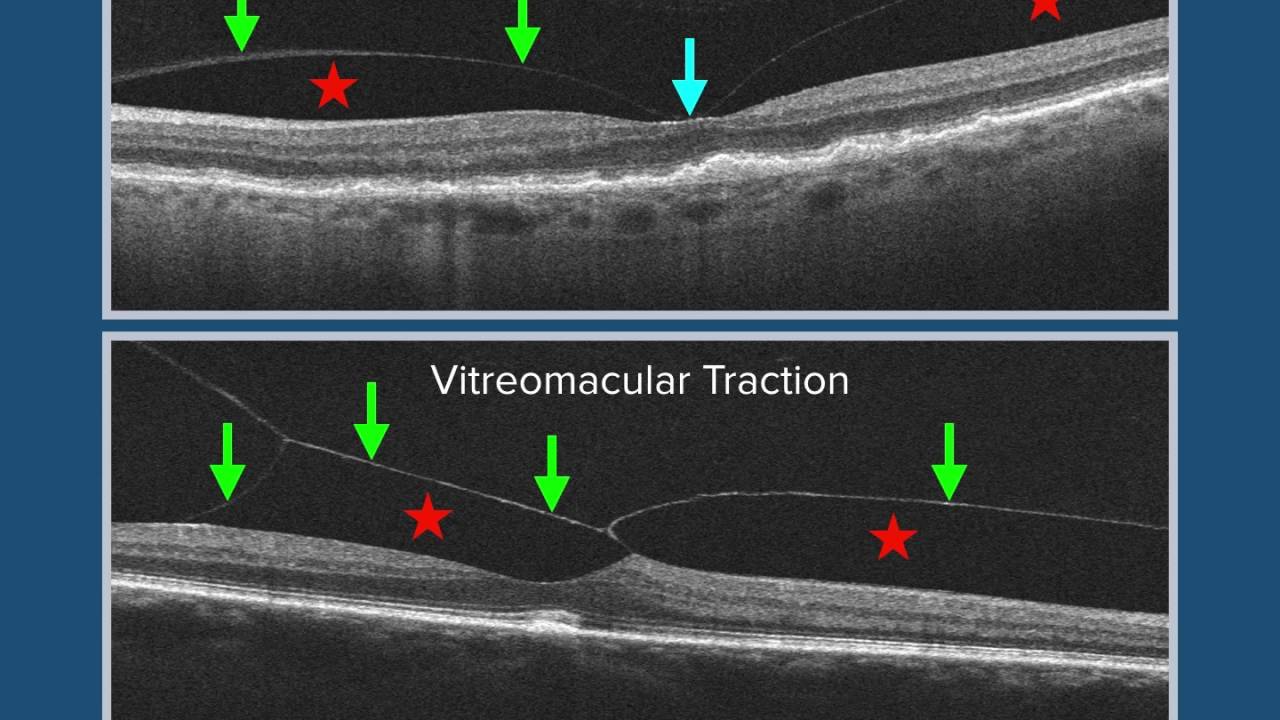 Vitreomacular Adhesion (VMA) vs. Vitreomacular Traction (VMT) - YouTube