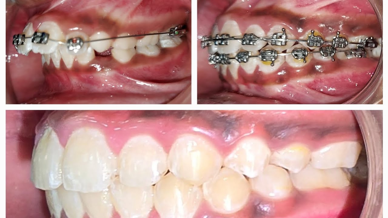 Class II Div I Malocclusion, Overjet of 8mm treated without Extraction ...