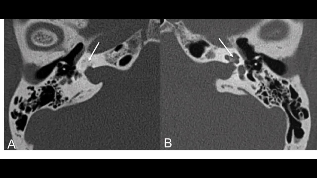 LABERINTITIS OSIFICANTE CAUSAS SÍNTOMAS Y TRATAMIENTO - YouTube