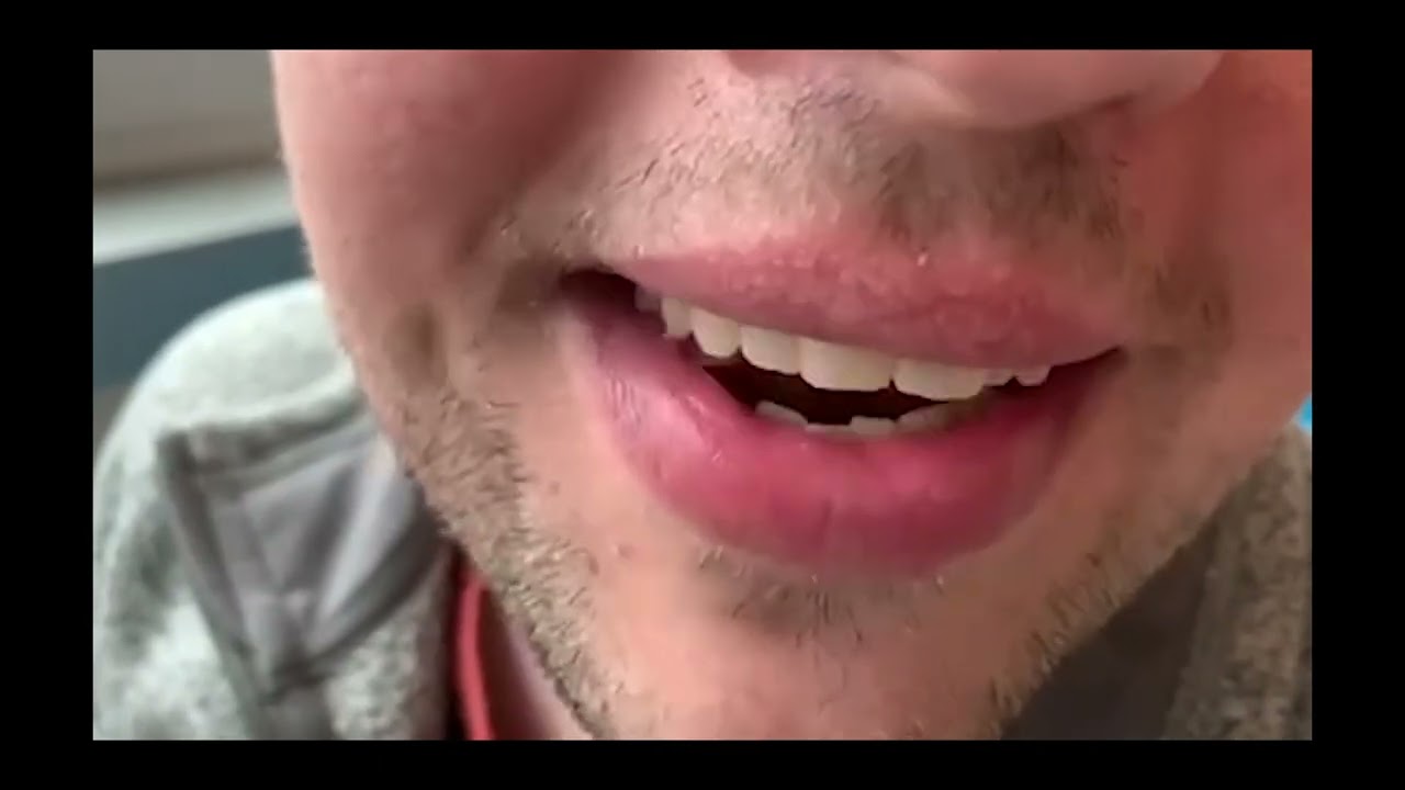 Voice Deepening/Masculinization Surgery, Prof Dr Kursat Yelken - YouTube