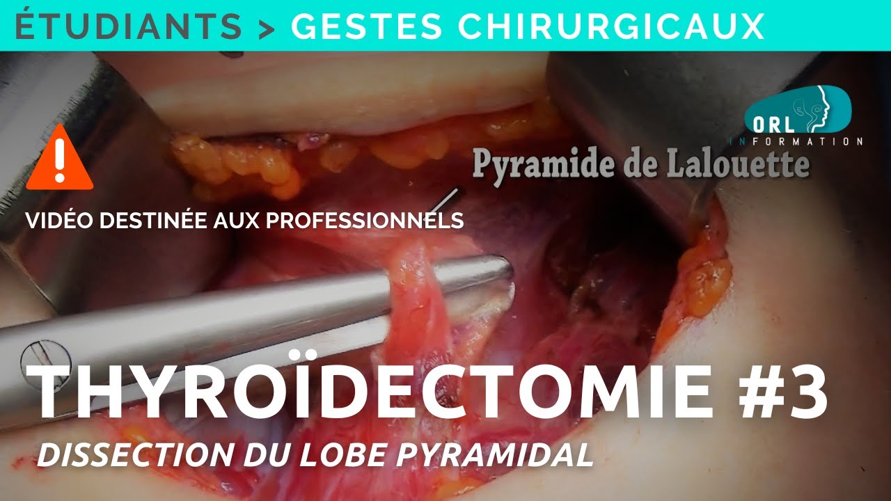 Comment réaliser une thyroïdectomie | #3 Dissection du lobe pyramidal ...