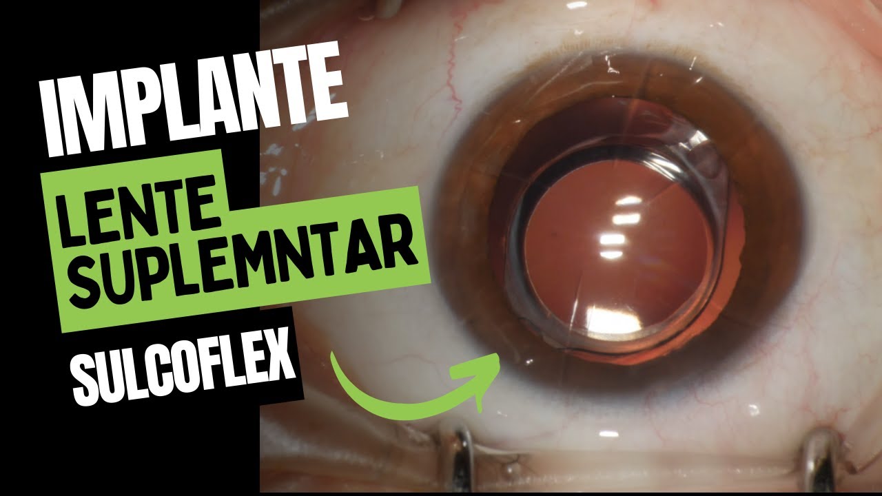 Implante de Lente Suplementar Sulcoflex - YouTube