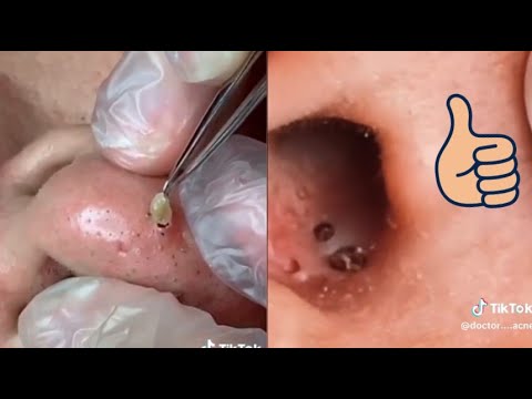 30 Min of the Most Satisfying Pimple Pops & Cyst Extractions | Ultimate ...