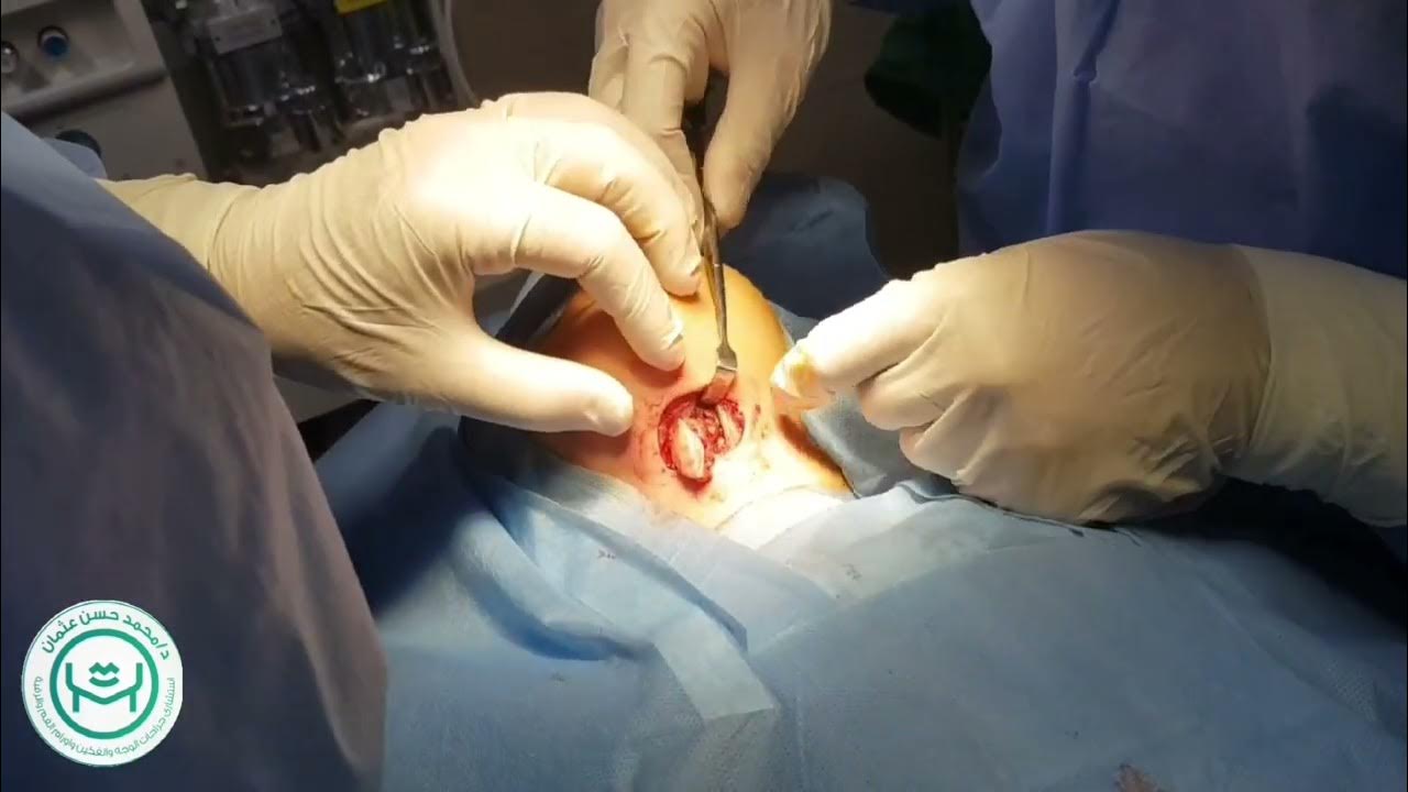 Sistrunk procedure for excision of a thyroglossal cyst by dr. Mohamed Hasan Osman - YouTube