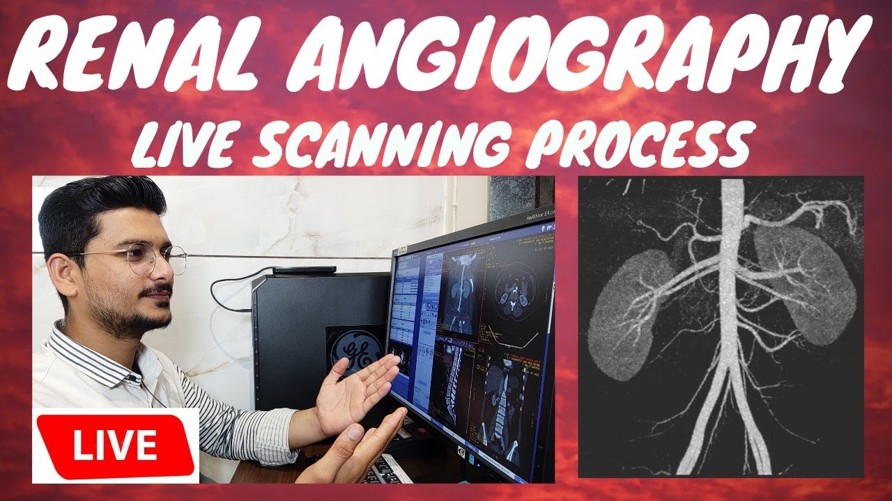 CT RENAL ANGIOGRAPHY LIVE SCAN | Live ct scan of renal/abdominal ...