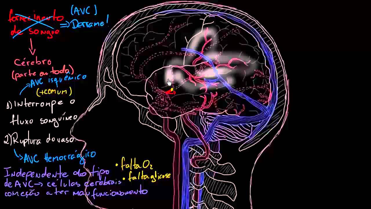O que é derrame? - YouTube