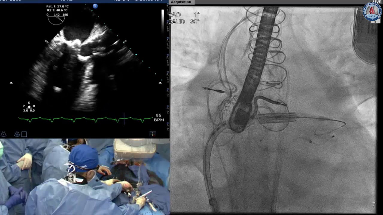 LAMPOON transseptal mitral valve in ring - YouTube