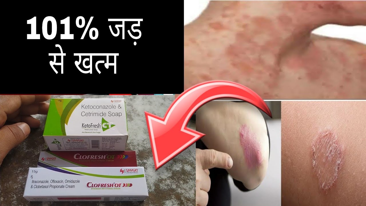 मात्र 5 दिन मे दाद खाज खुजली को जड़ से खत्म Clofresh Ot cream v/s ...