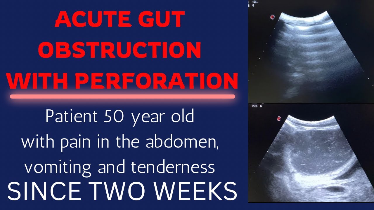 @ultrasoundlearning | Acute | Acute Gut obstruction and perforation ...