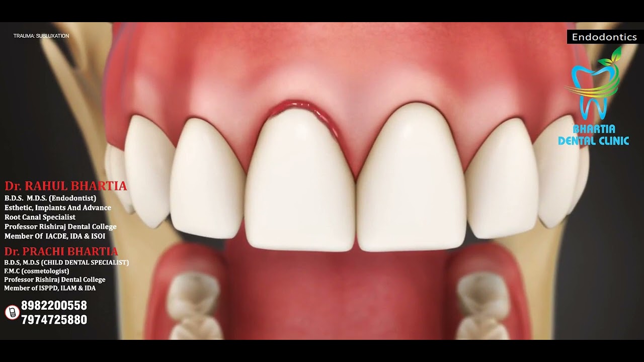 Tooth Subluxation : What You Need to Know by Bhartia Dental Clinic ...
