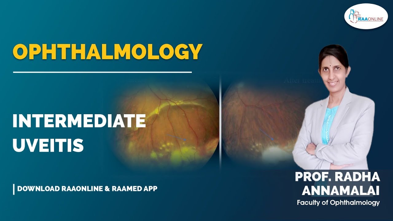 Ophthalmology | Intermediate Uveitis | Raaonline #ophthalmology # ...
