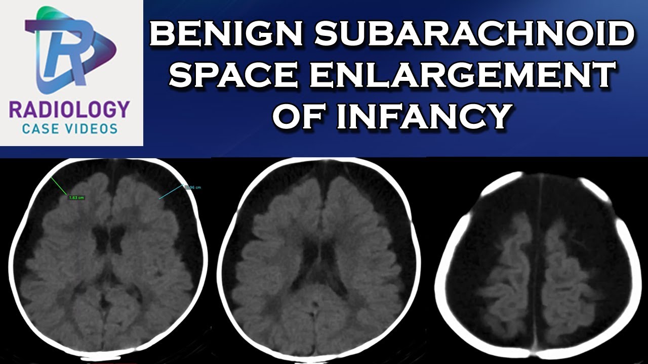 Benign Subarachnoid Space enlargement of infancy - YouTube