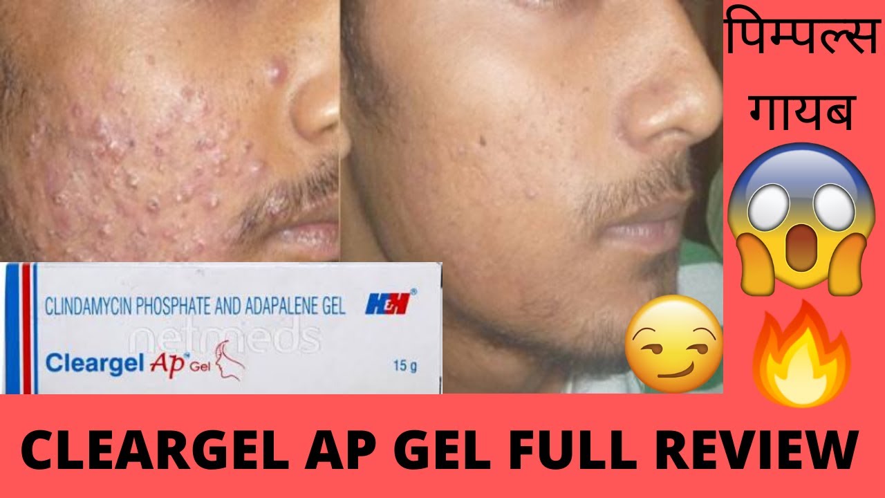 Cleargel AP Gel Review Effect and Side effect Best for Acne पिम्पल्स ...