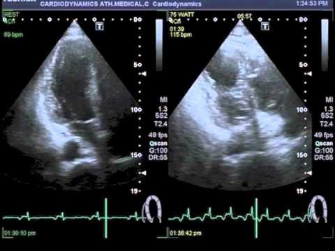 exercise-induced WMA during stress echo in CAD - YouTube