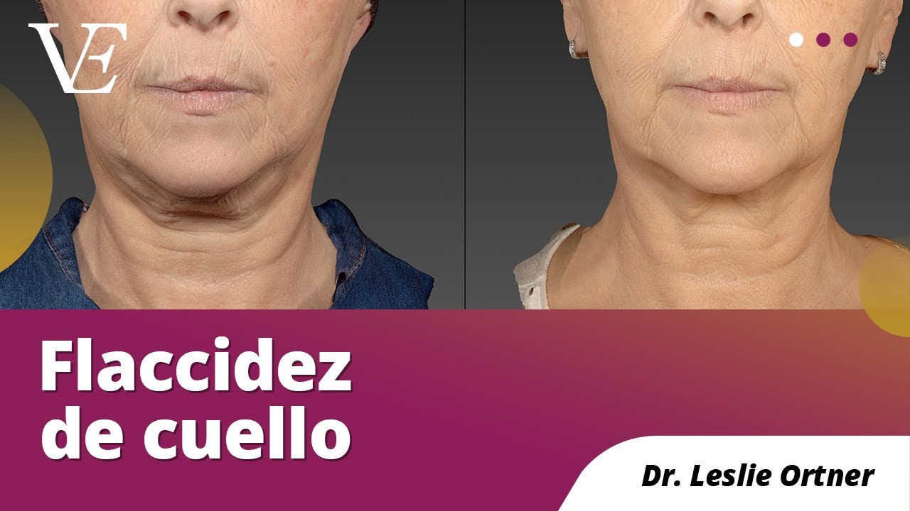 CÓMO TRATAR LA FLACCIDEZ DEL CUELLO con Ácido Hialurónico y ...