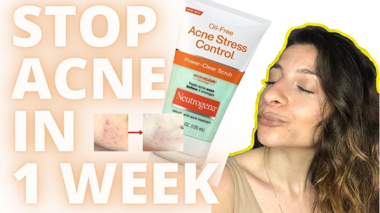 I USE THIS TO PREVENT, STOP AND CURE ACNE (Acne-Stress Control ...