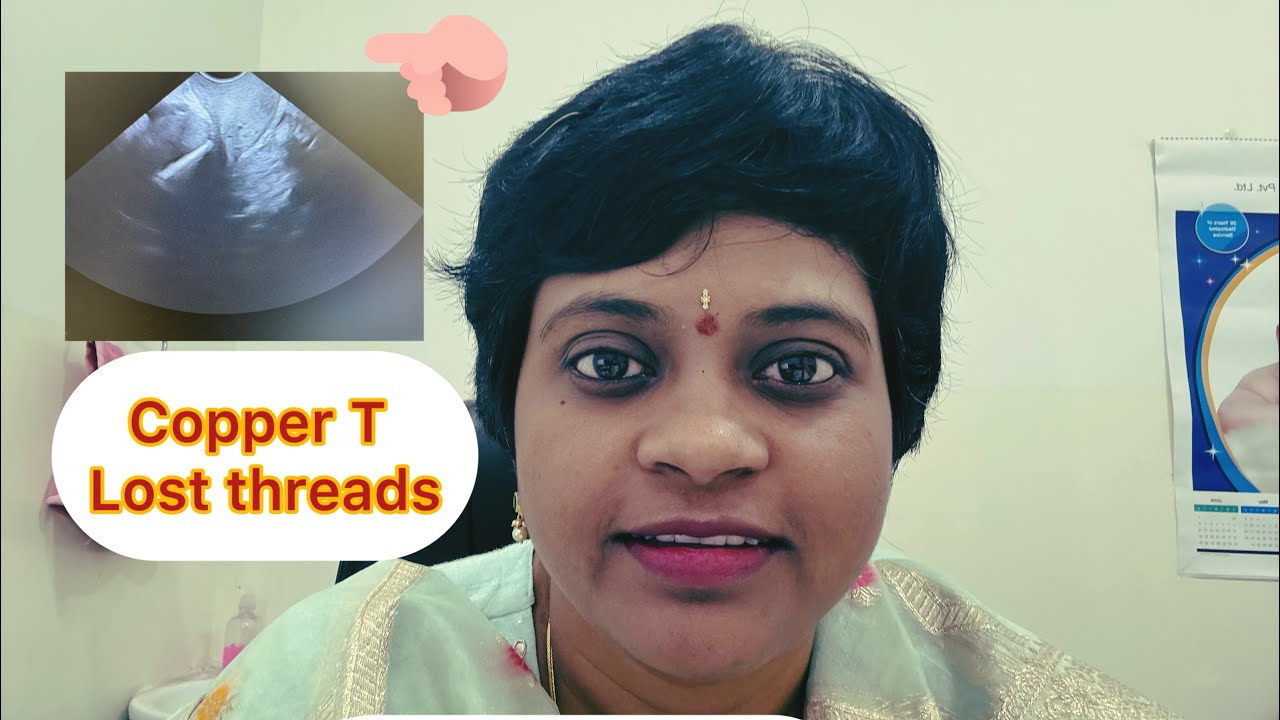 Copper T threads lost# ఏమి చేయాలి#doctorday#scan - YouTube