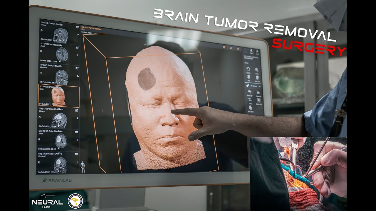Brain Tumor - Augmented reality Surgery with BrainLab - YouTube