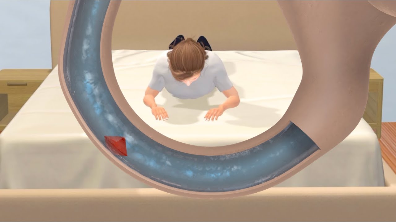 Lempert (BBQ) Maneuver to Treat BPPV Vertigo - YouTube