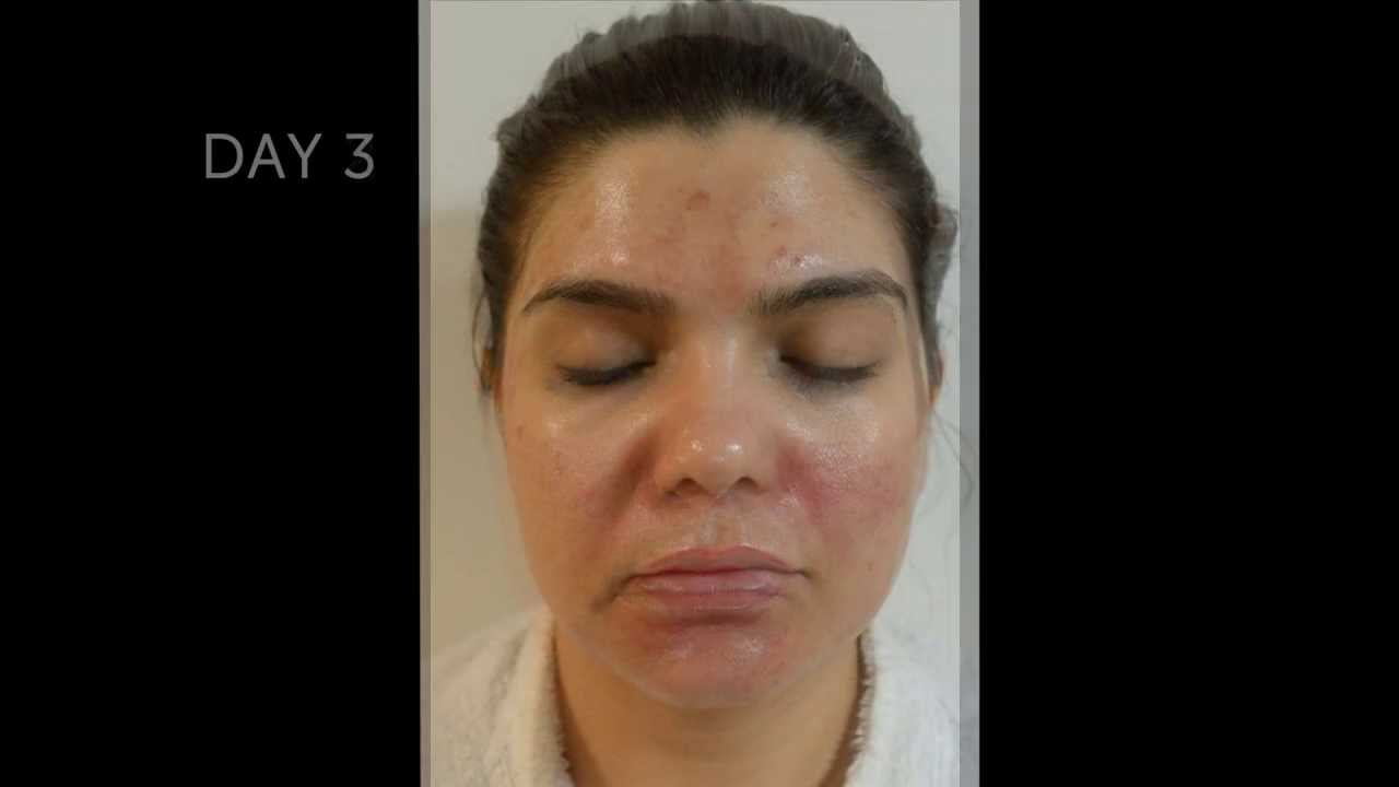 Acne Scar Treatment: TCA Peel By Dermaquest - YouTube