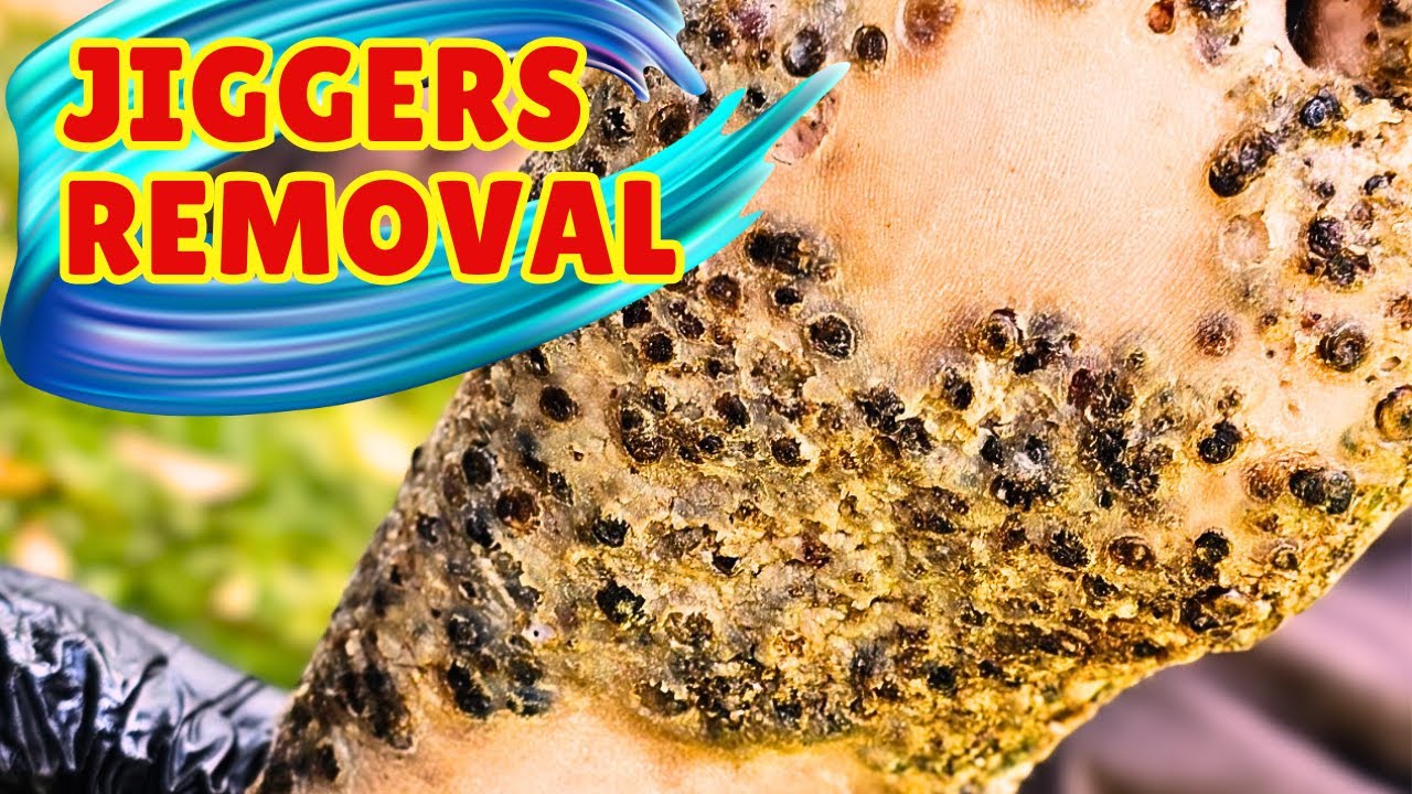 insane jigger removal! 🔬 deep extraction & parasitology wonders - YouTube