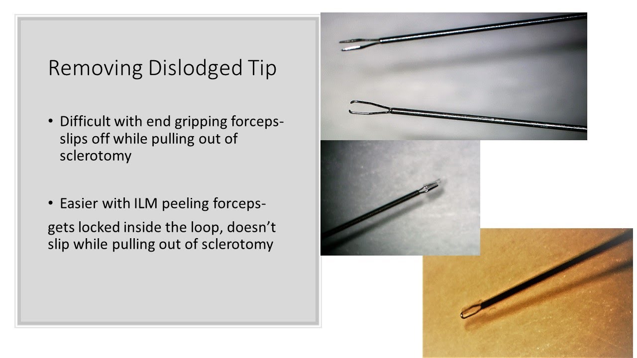 A tip to remove the Dislodged Silicon Tip - YouTube