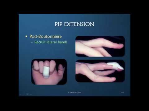 Obstinate PIP Joint: Part 10 of 12: Active Redirection for PIP Joint ...