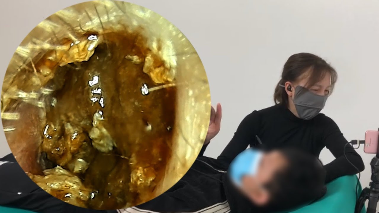 Ear wax removal | ear cleaning | ASMR | relaxation EP17 - YouTube