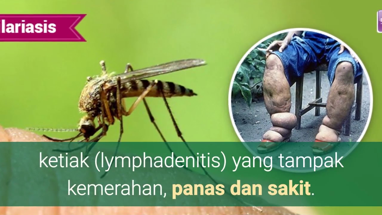 Penyebab Kaki Gajah dan Ciri Cirinya - Yuk Kenali dan Cegah Penyebab ...