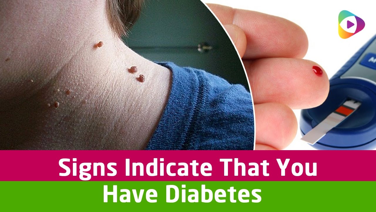 Signs Indicate That You Have Diabetes! - Health Tips - YouTube