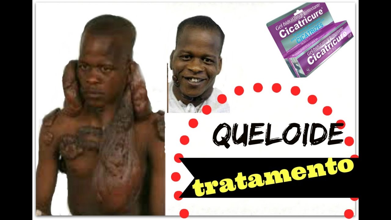 QUELOIDE E SEUS TRATAMENTOS - VARIAS FORMAS DE ELIMINAR QUELOIDES - YouTube