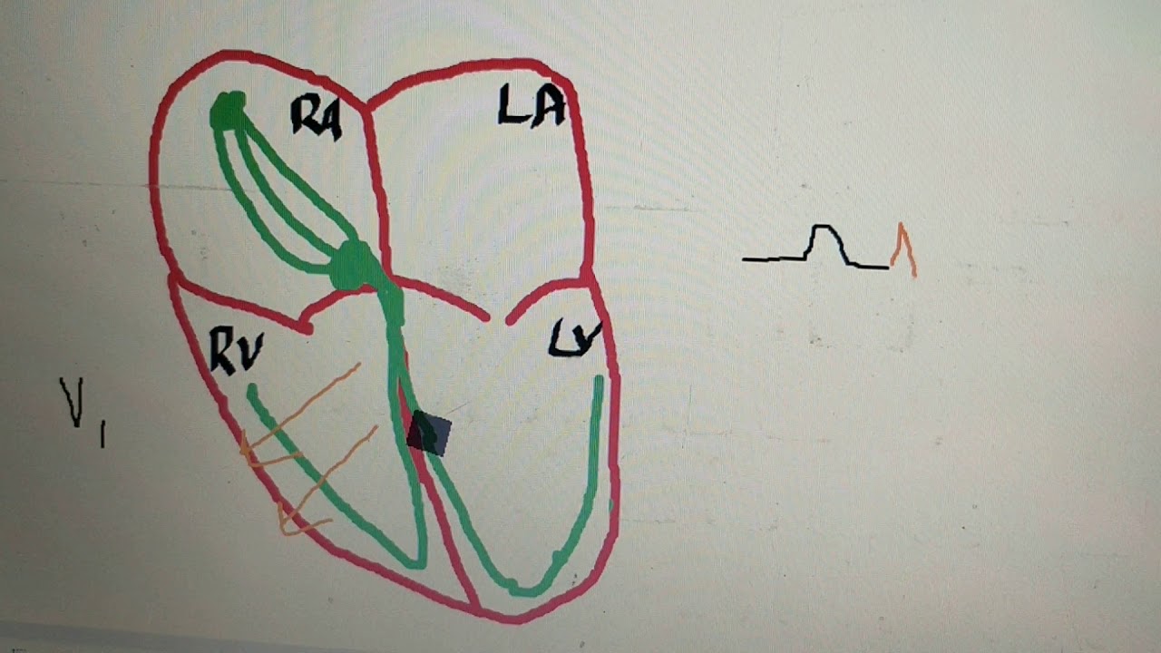 bundle branch and hemifascicular blocks - YouTube